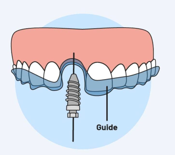 3D Guided Implant Surgery in Dubai | Precision Dental Implants